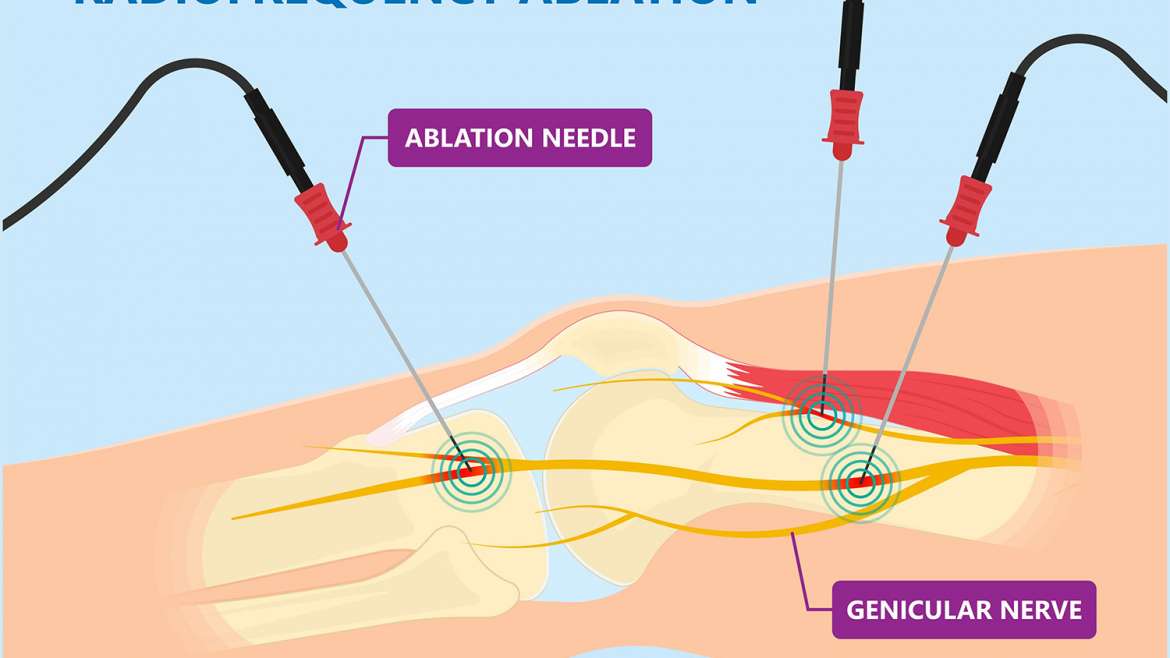 Arthritis Center – Spine Sports & Interventional Pain Medicine